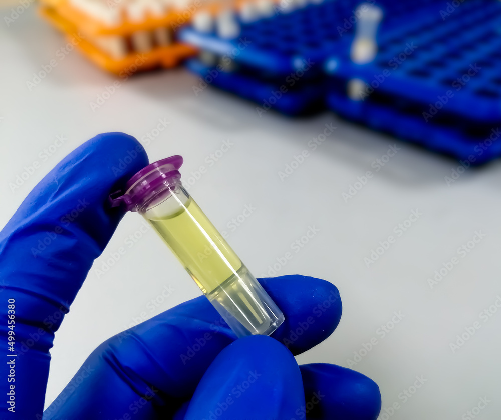 Eppendorf Tube with Cerebrospinal fluid (CSF) sample for pathological ...