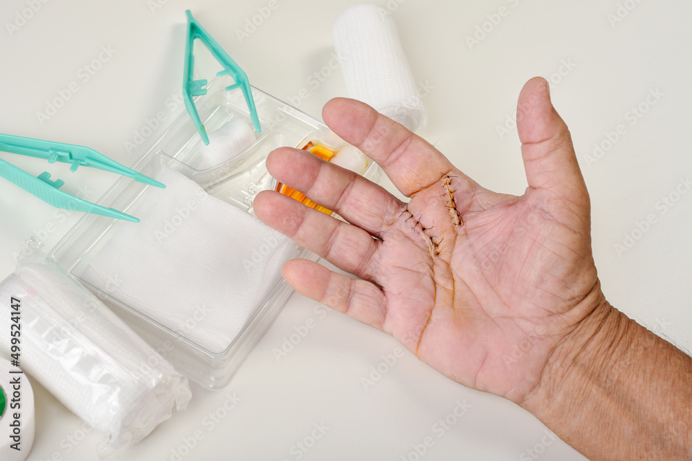 Doctor doing wound dressing care, Hand surgery treatment, Trigger ...