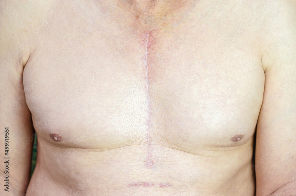 Shirtless Caucasian man with scar mark from CABG (Coronary Artery ...