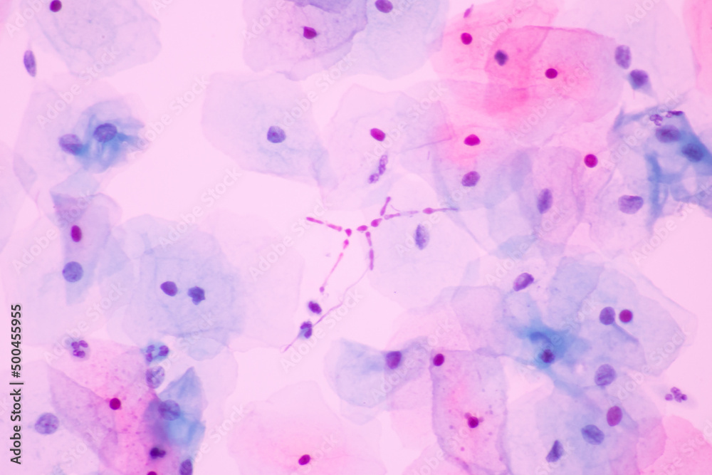 View in microscopic of Candidiasis, fungus infection (Yeast and ...