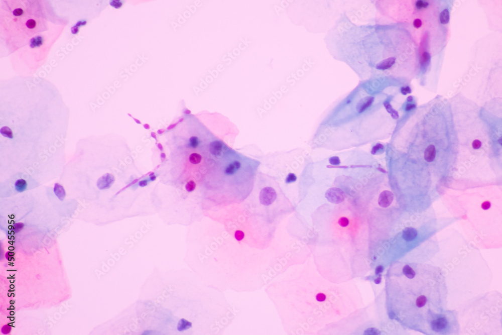 View in microscopic of Candidiasis, fungus infection (Yeast and ...