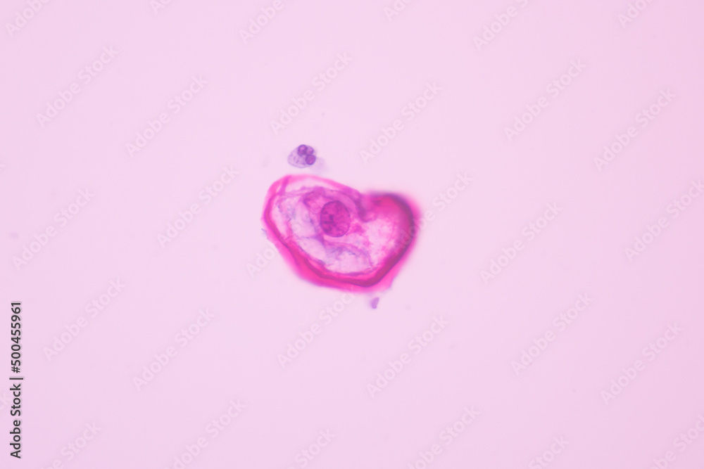 Abnormal squamous epithelial cells view in microscopy.HPV criteria for ...