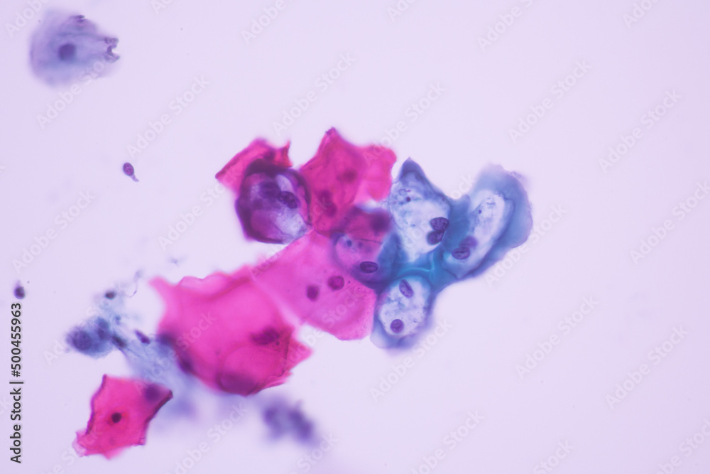 Abnormal squamous epithelial cells view in microscopy.HPV criteria for ...