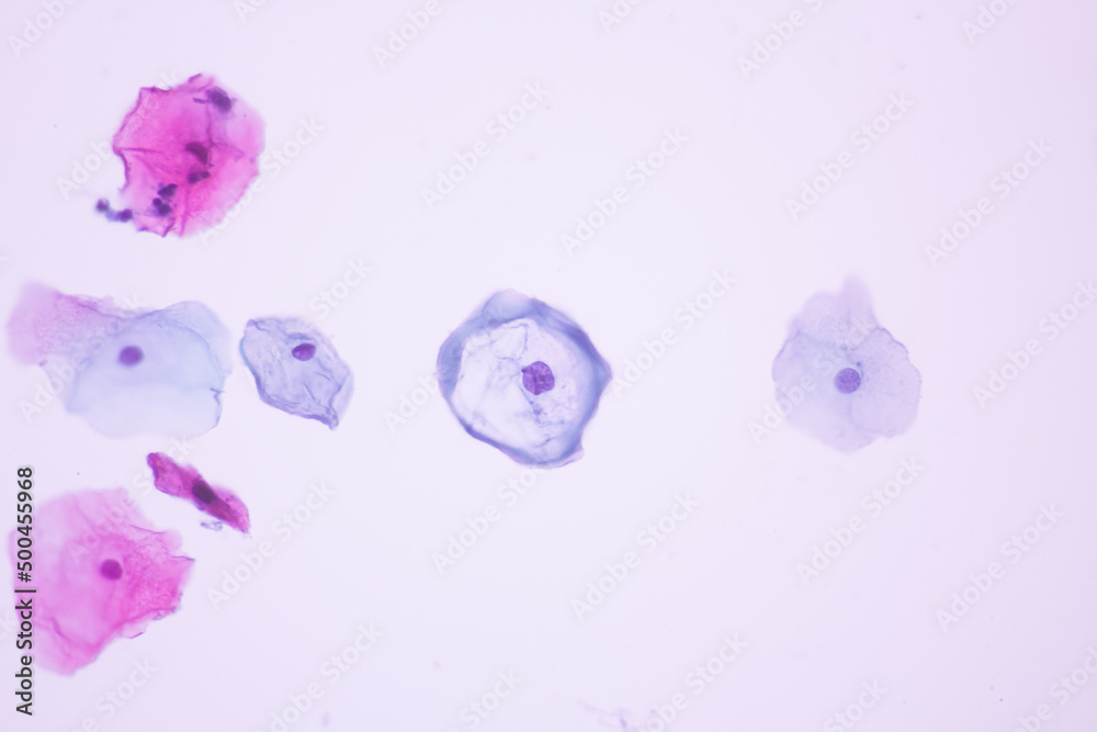 Abnormal squamous epithelial cells view in microscopy.HPV criteria for ...