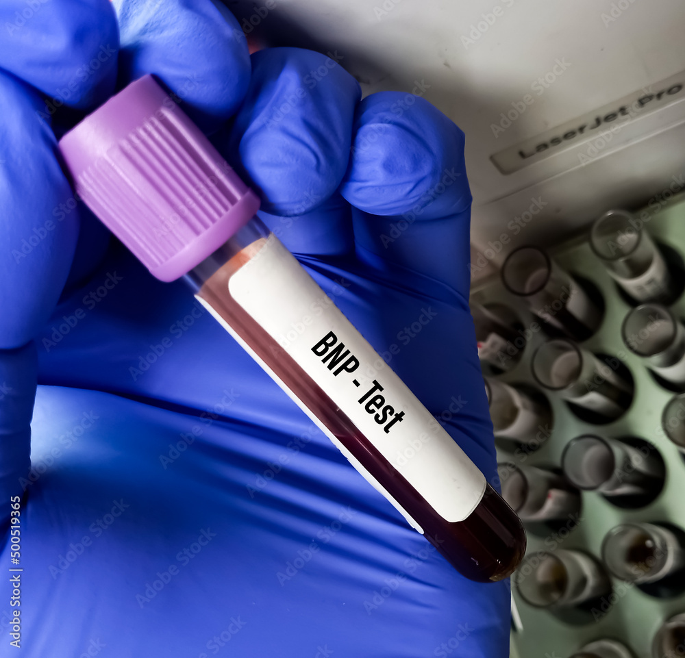 Blood sample for BNP(Brain natriuretic peptide) test, NT-proBNP test ...