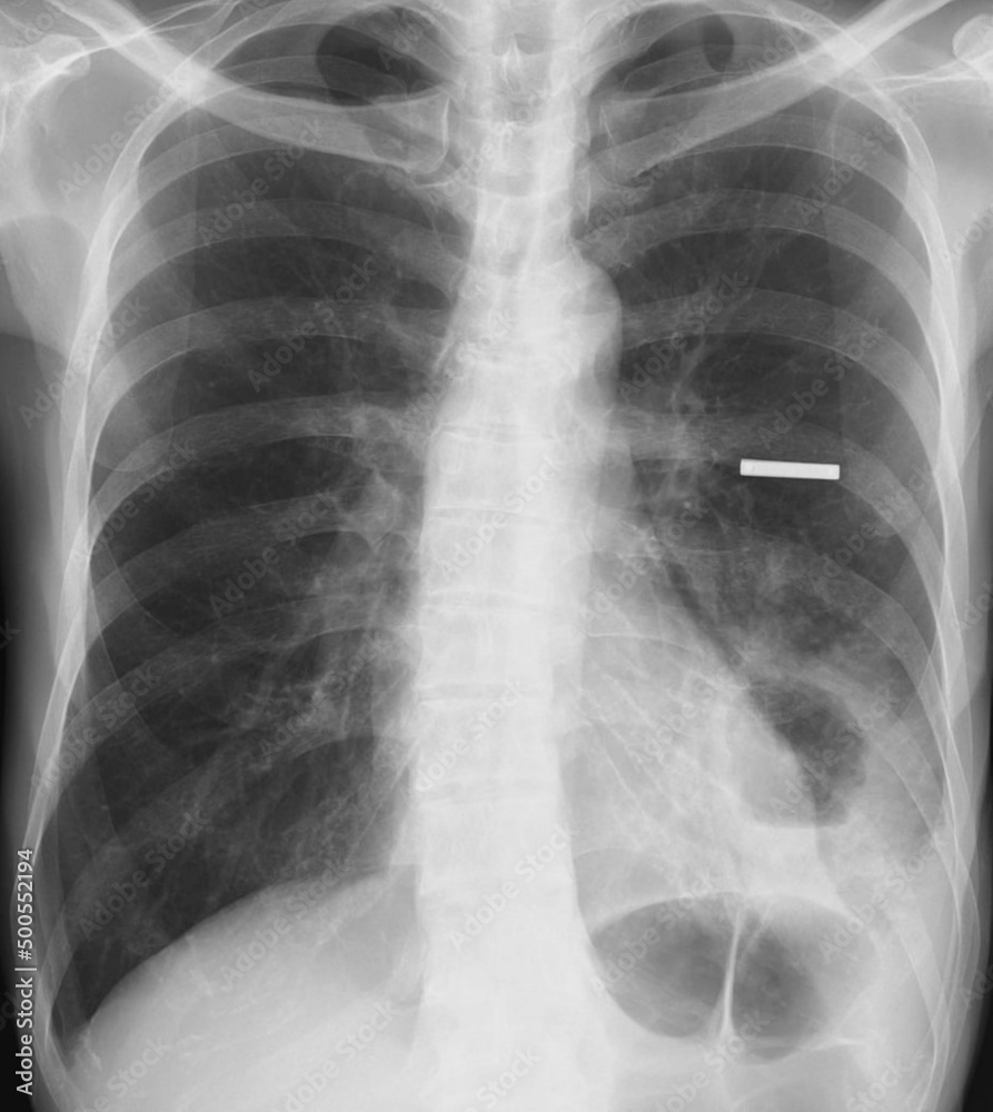 chest x-ray image of lung abscess Stock Photo | Adobe Stock