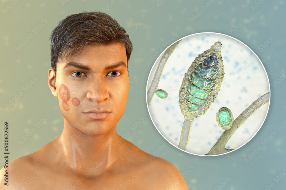 Stockillustrationen Fungal infection on a man's face, 3D illustration ...