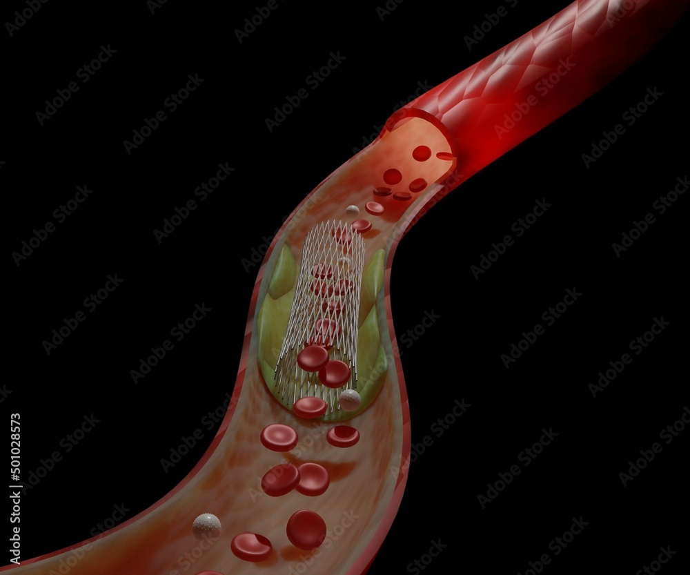 A stent is a mesh tube placed in a blood vessel. It's used to increase ...