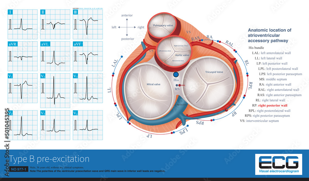 Male, 36 years old, without any clinical symptoms. Type B preexcitation ...