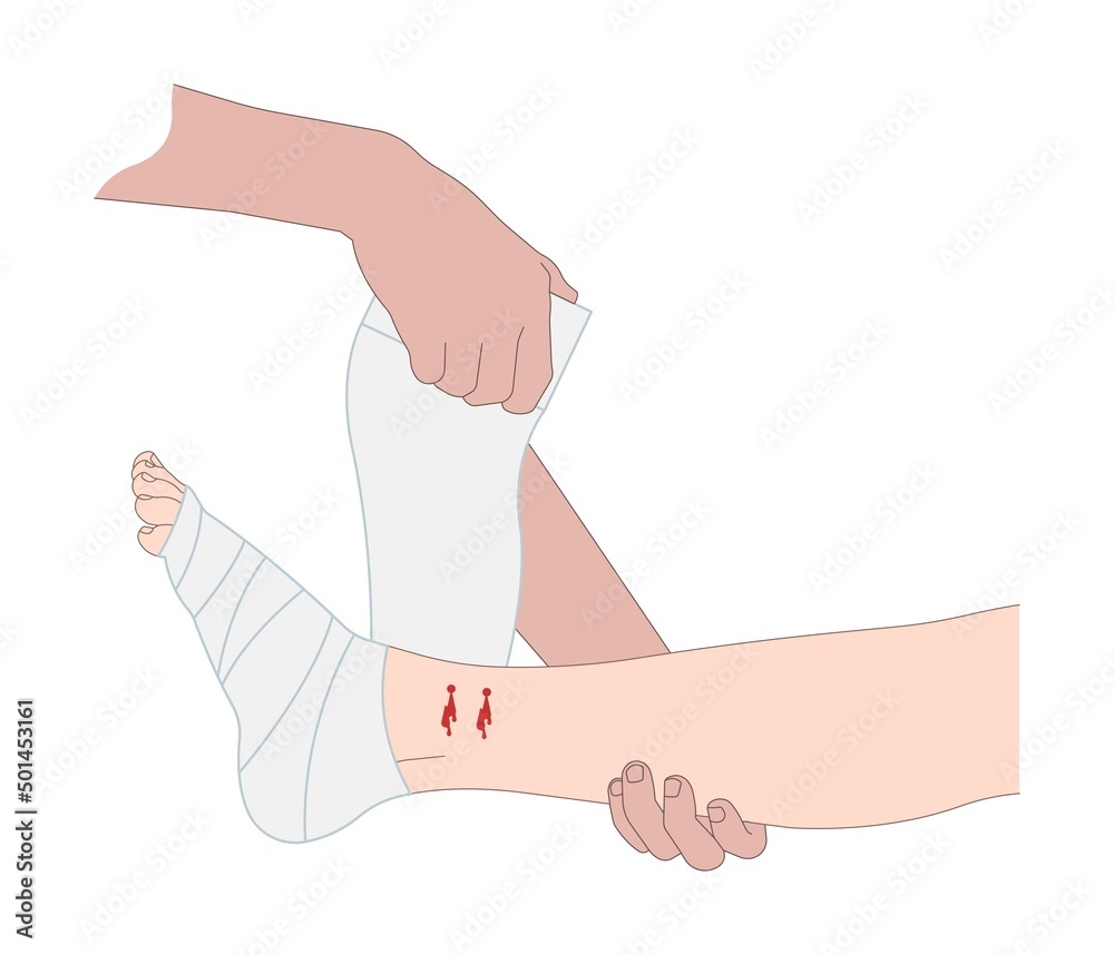 Стоковое векторное изображение «Snake Bite First Aid care non venomous ...