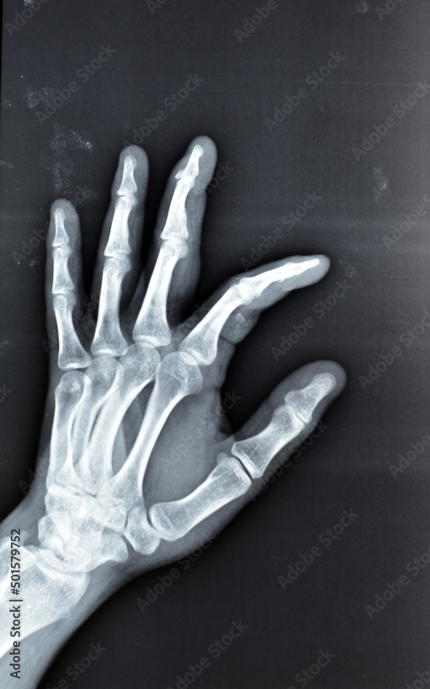 Plain x ray shows avulsion fracture base of the distal phalanx of the ...