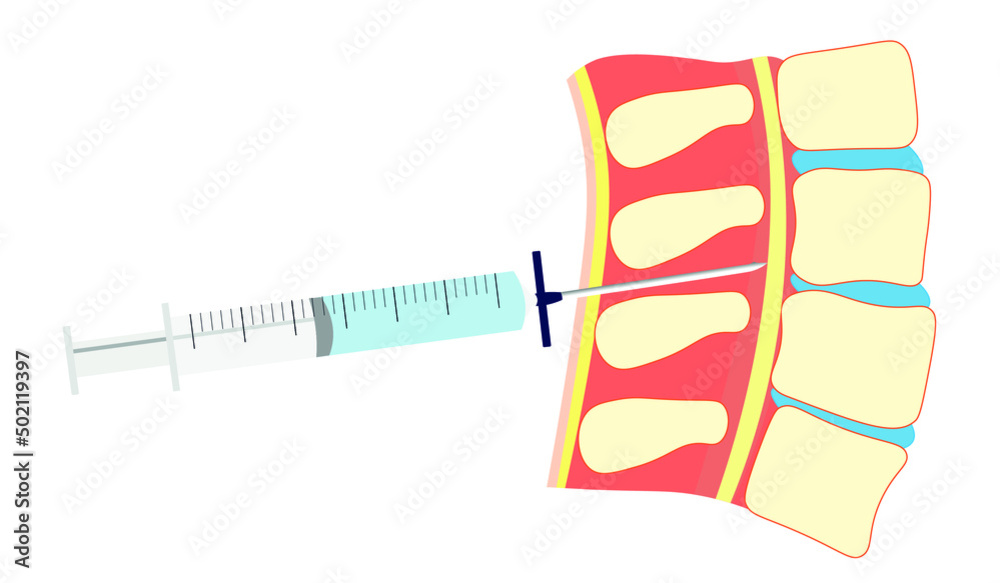 Epidural needle position in a Spinal. Epidural injection with a syringe ...
