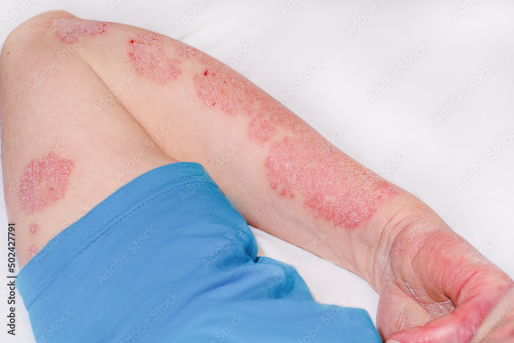 Acute psoriasis on the arm of a man, severe redness on the skin, an ...