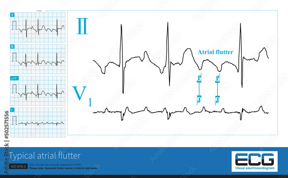 Male, 58 years old, clinically diagnosed as COPD. Paroxysmal atrial ...