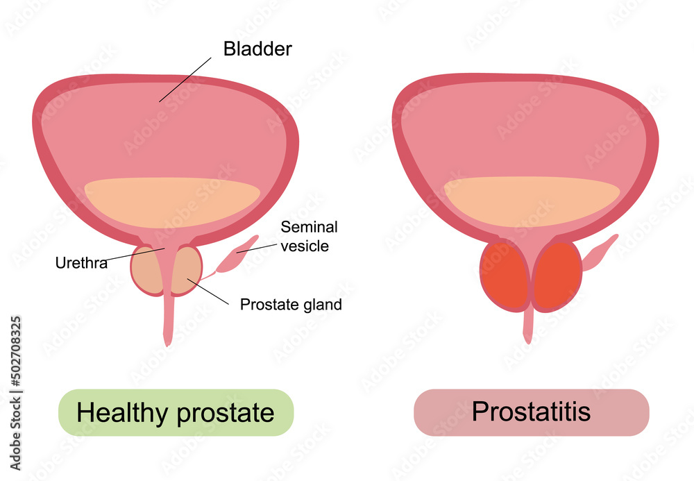 Illustration Stock Healthy prostate, prostatitis and prostate cancer. Illustration of male ...