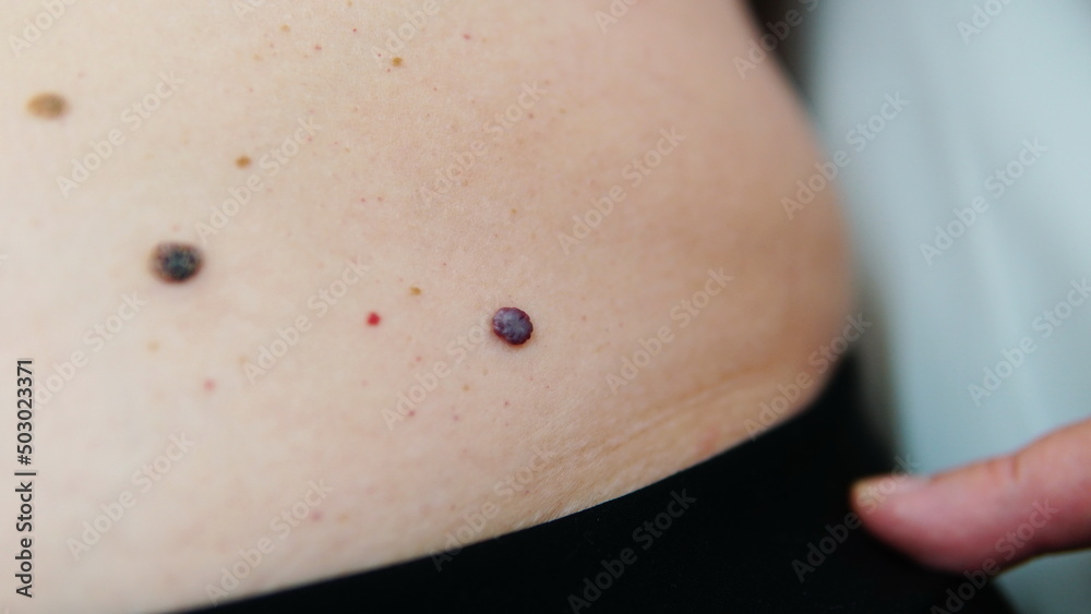Red moles and dots on the female body. Large mole on stomach. Melanoma ...