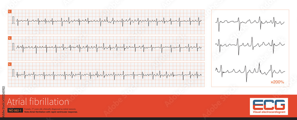 Female, 37 years old, clinically diagnosed with mitral stenosis. The ...
