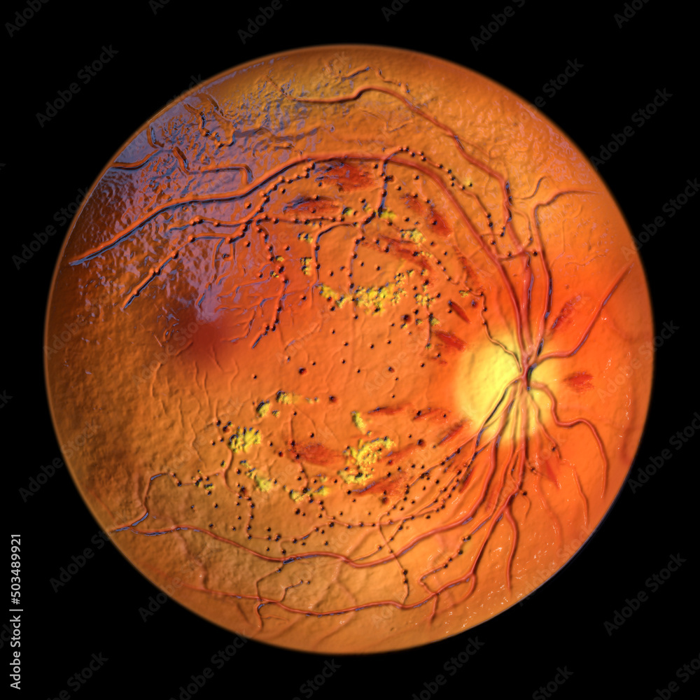 Diabetic retinopathy, ophthalmoscopic diagnosis, illustration Stock ...