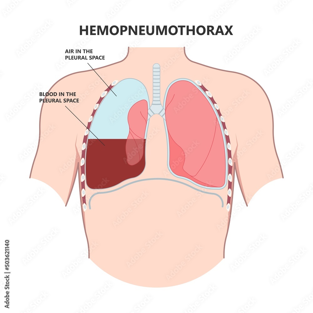 Lung cancer collapse chest pain drain rib bleb blunt insert tube fluid ...