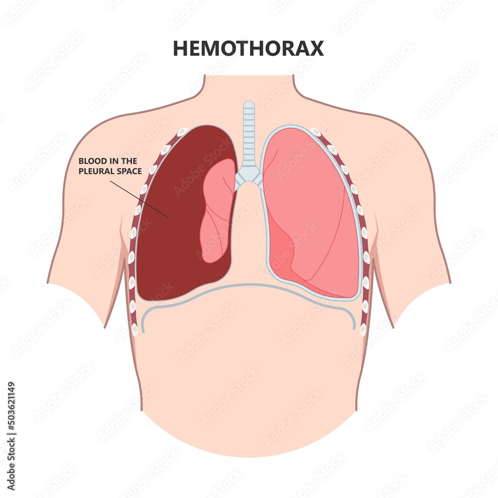 Lung cancer collapse chest pain drain rib bleb blunt insert tube fluid ...
