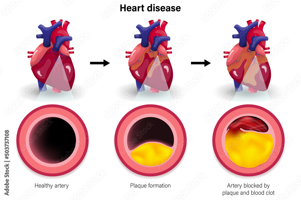 Heart disease. Coronary artery syndrome. Causes of myocardial ischemia ...