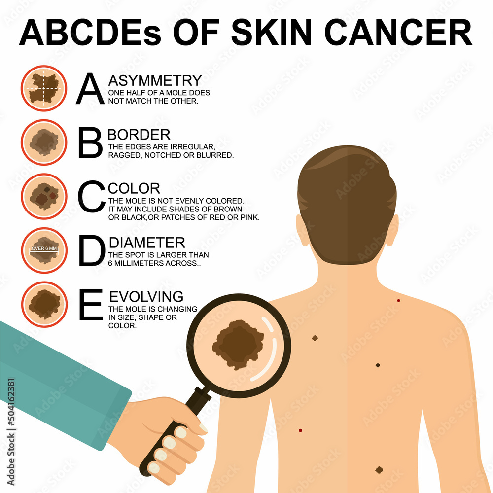 Diagnosis of skin cancer. Melanoma warning signs. Dermatological ...