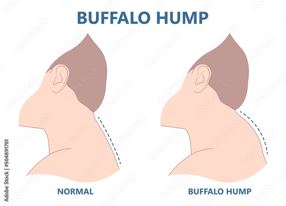 buffalo dowager's hump head bad poor women spine pad excess shape High ...