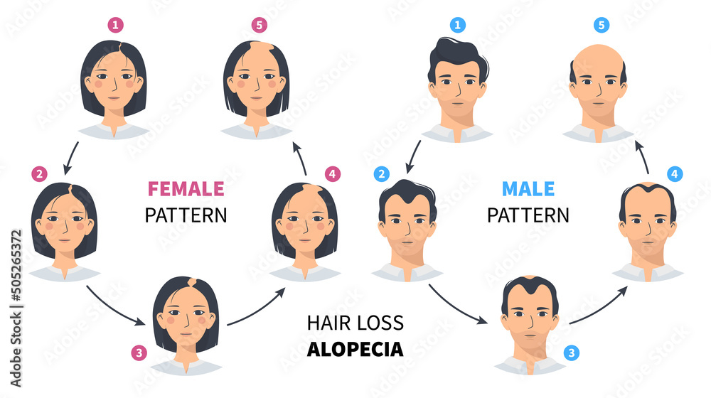 Hair loss stages, androgenetic alopecia male and female pattern. Steps ...