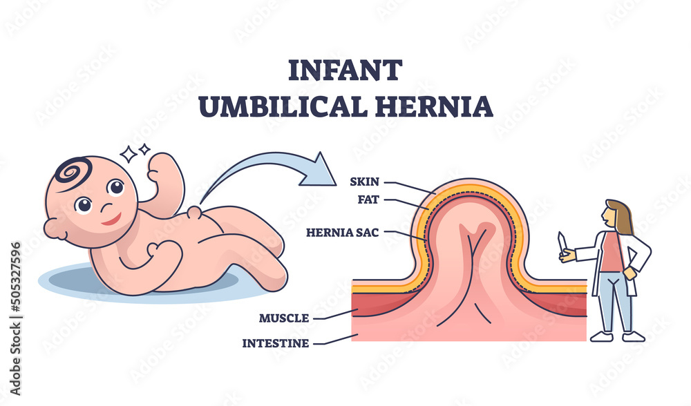 Infant umbilical hernia as painless lump near belly button outline ...