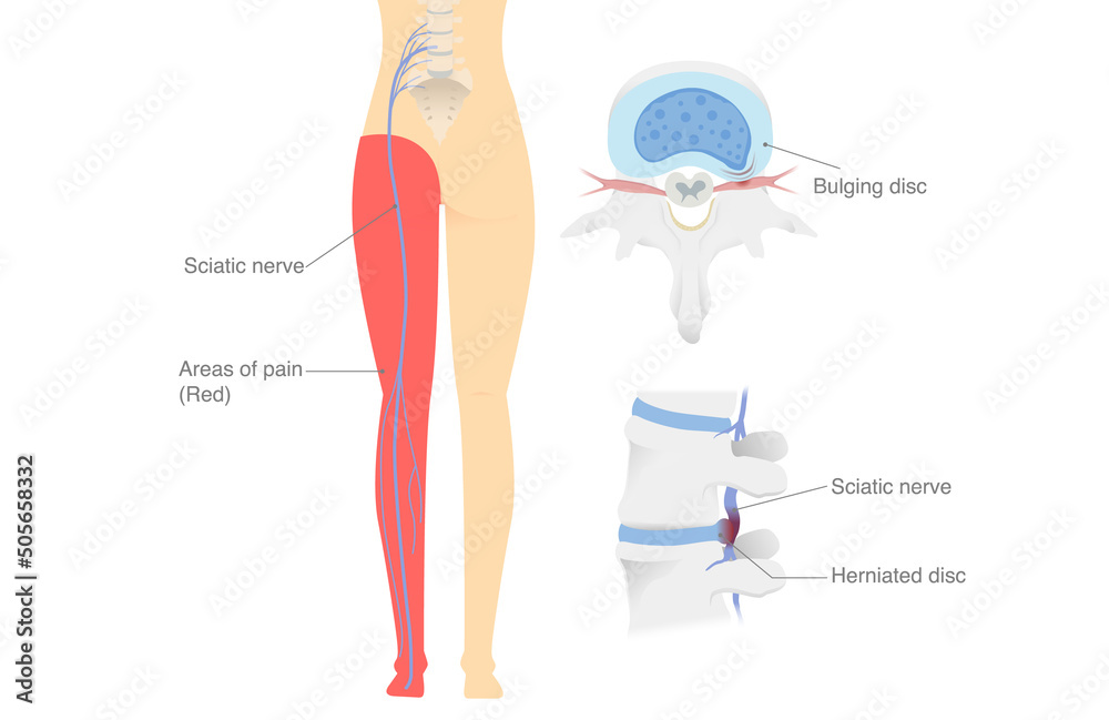 Diagram shows the Sciatica nerve from a herniated disc and trapped ...