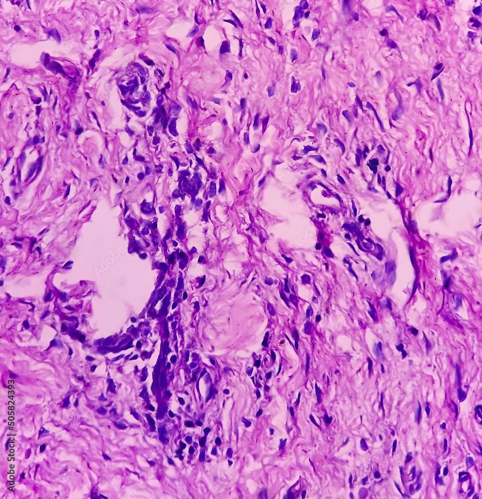 Metatarsophalangeal joint biopsy: show fibrocollagenous tissue and ...