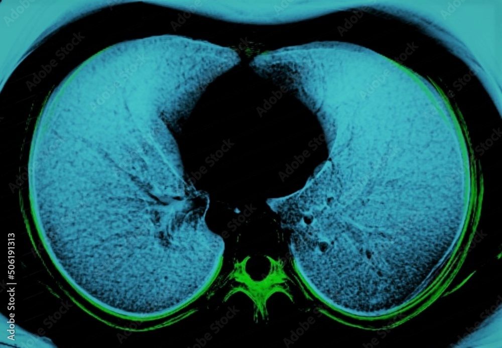 Foto de Stock Colored 3d chest ct scan showing heart,lung, vascular ...