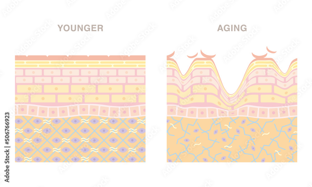 Cross section of subcutaneous tissue. Smooth younger skin and wrinkled ...