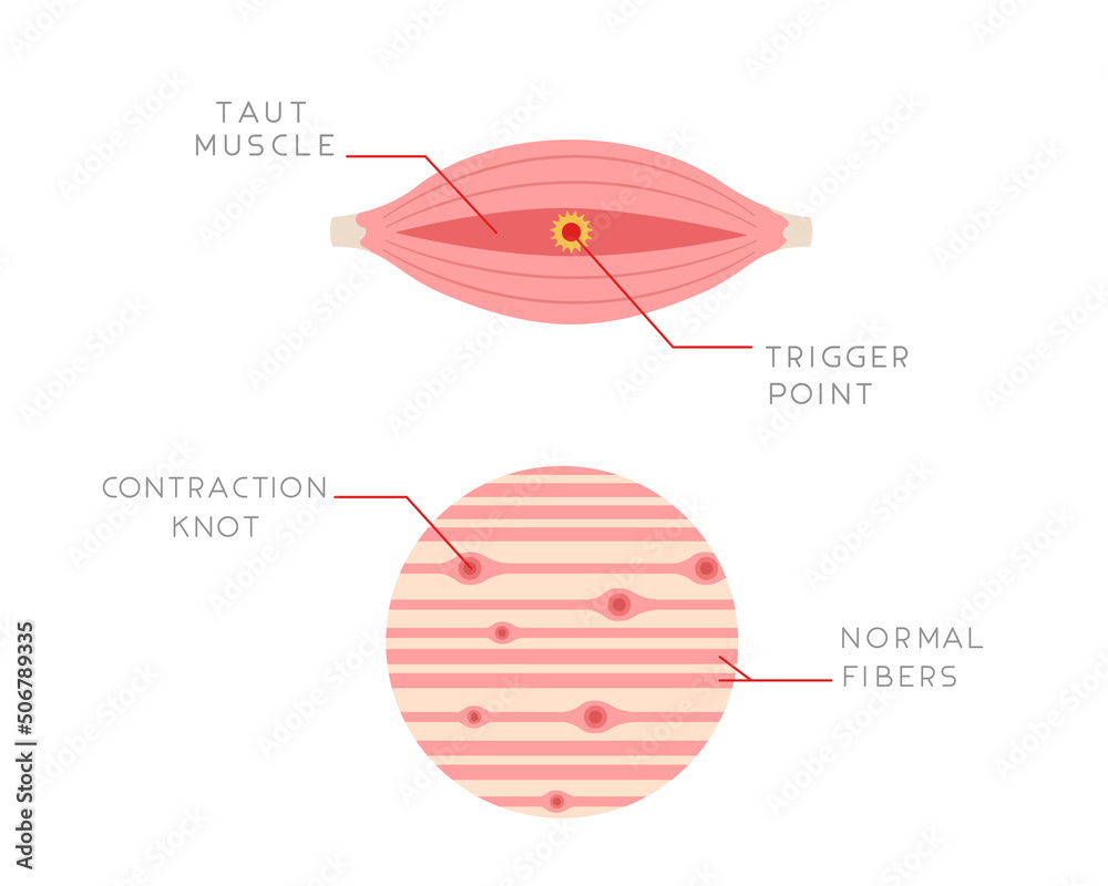 Illustration of a trigger-point complex at a longitudinal section of ...