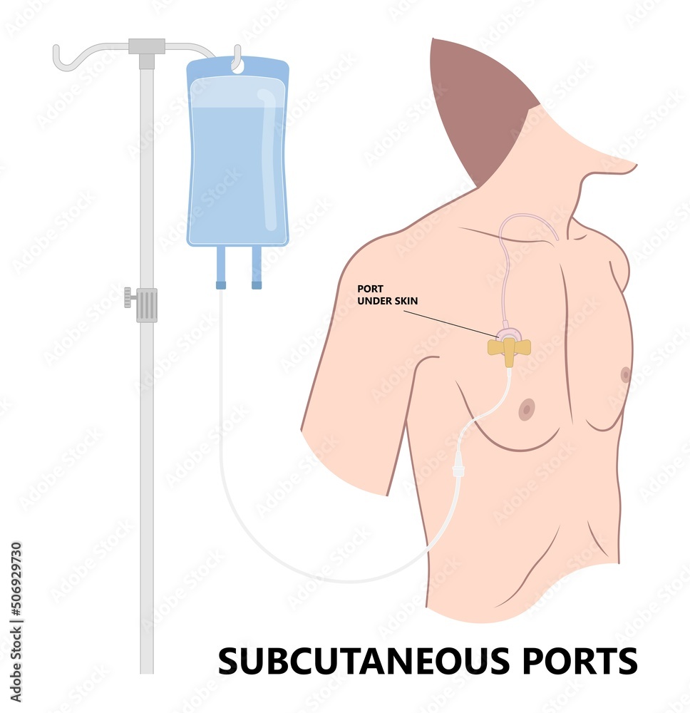 Image vectorielle Stock PICC Line insert neck tube vein arm blood draws ...