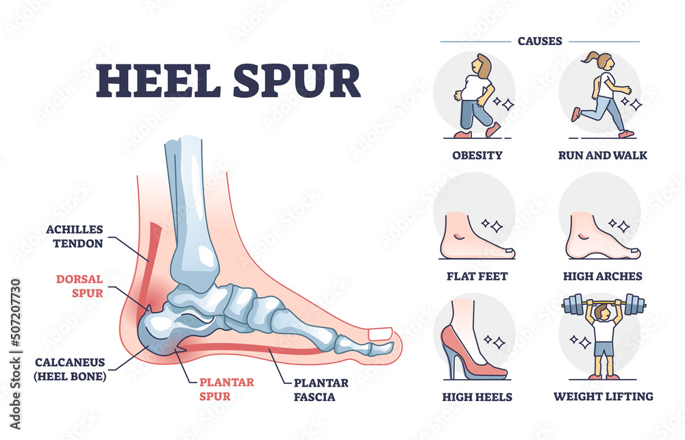 Heel spur problem or calcaneal bone condition causing pain in feet outline diagram. Labeled educational medical scheme with achilles tendon and plantar fascia inflammation anatomy vector illustration....