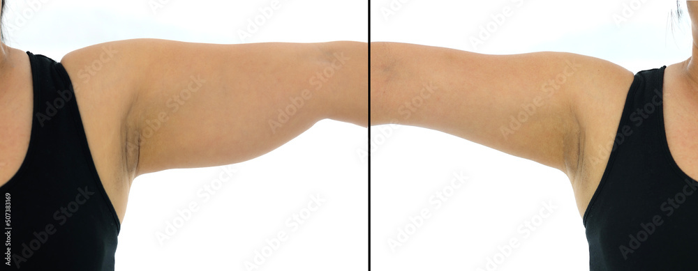 Comparison before and after Obesity Cellulite And Fat Removal ...