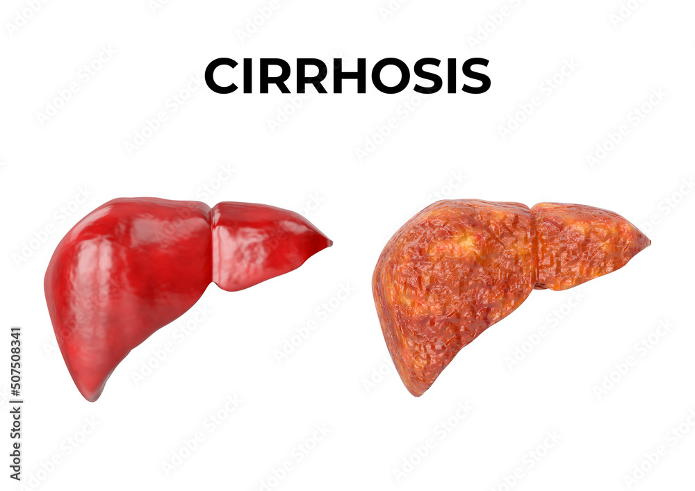 Liver cirrhosis is a chronic inflammation of the liver, a fibrous ...