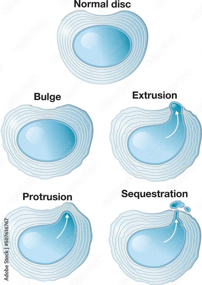 Herniated disc schema. Normal disc. Bulge. Protrusion. Extrusion ...