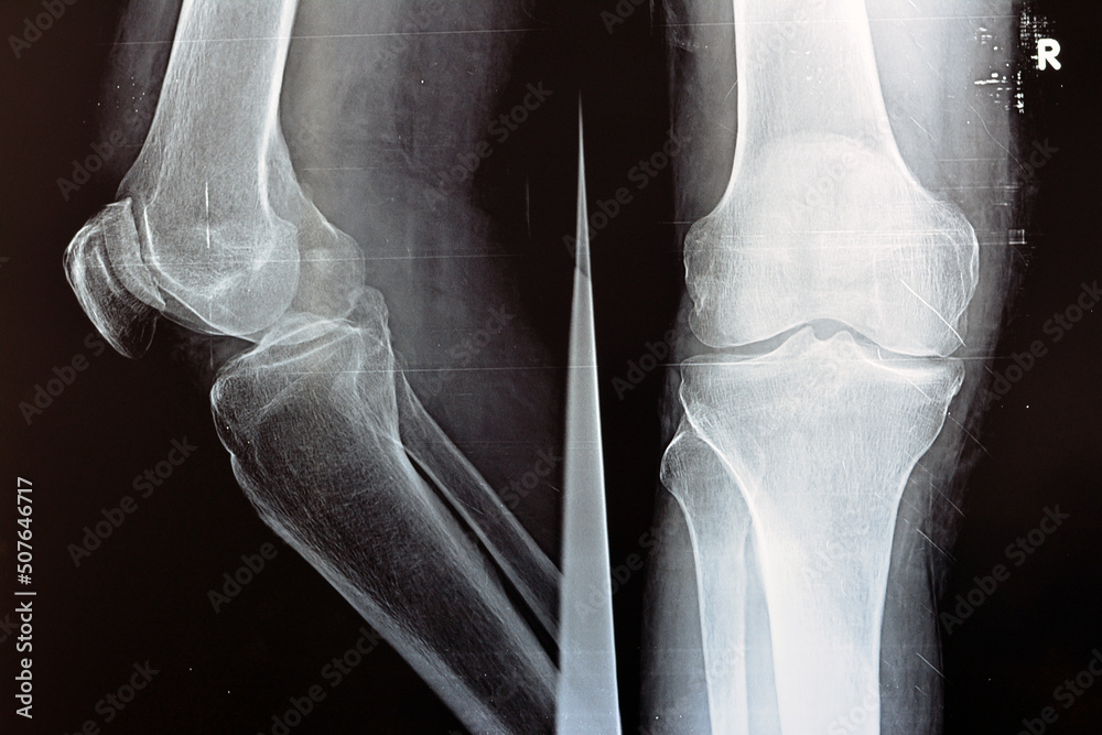 Plain X ray of the right knee shows apparent joint osteoarthritis ...