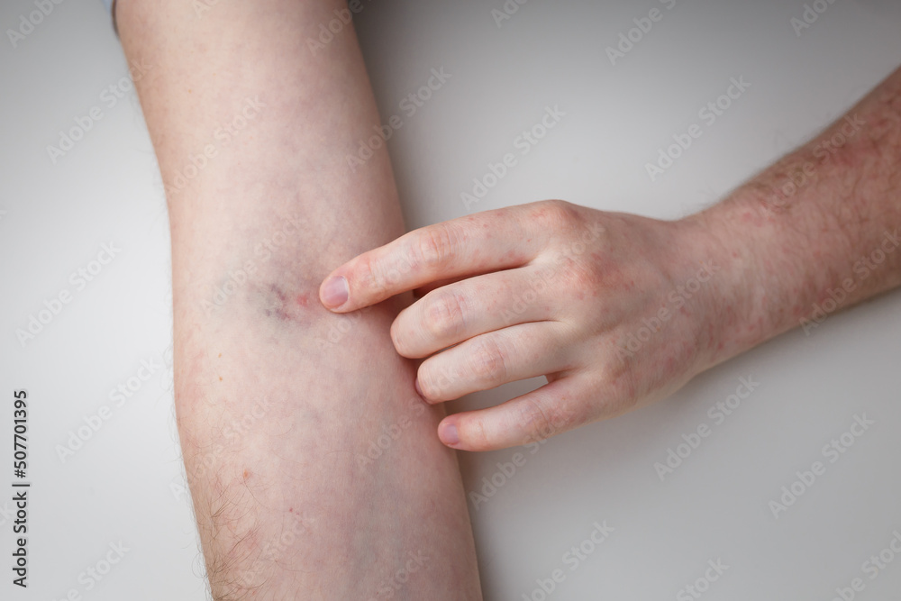 Patient showing syringe injection mark on arm with reddness and blue ...