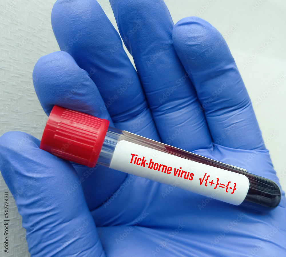 Blood sample for Tick borne virus test, Crimean Congo hemorrhagic fever ...