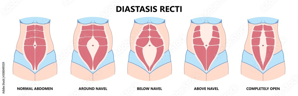 Diastasis Recti six pack separation belly rectus Linea alba abdominal ...