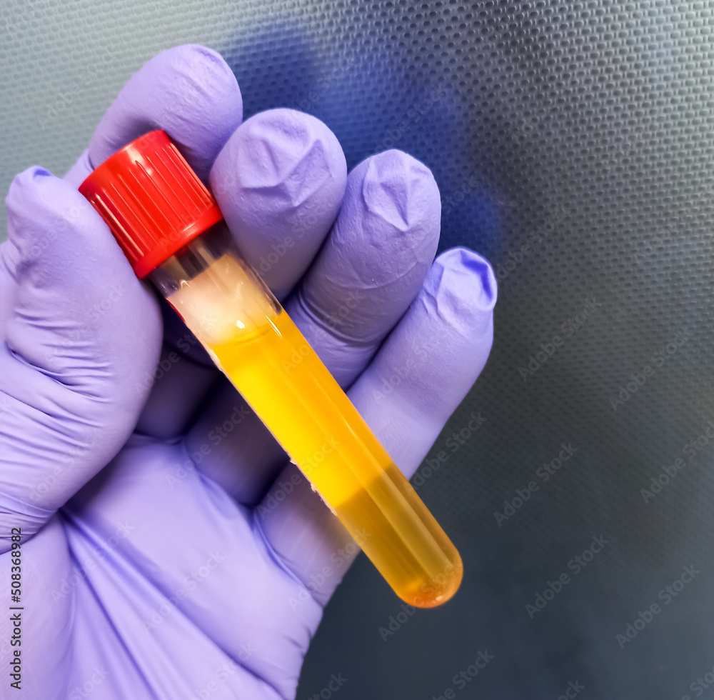 Technologist hold test tube with Pleural fluid which is ready for ...