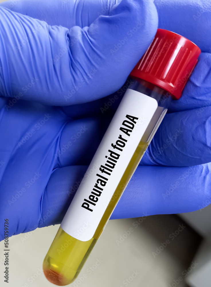 Medical technologist hold Pleural fluid sample for ADA test, Pleural ...