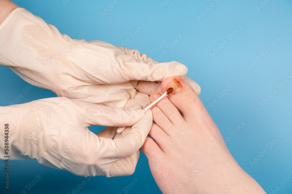 doctor disinfect the injured toenail. Hands in rubber gloves touch ...