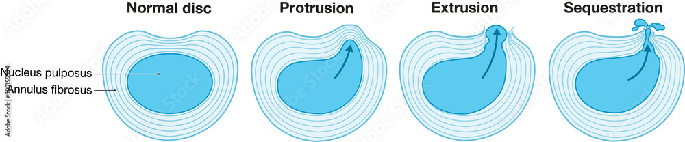 Ilustración de Stock Herniated disc schema. Normal disc. Bulge ...