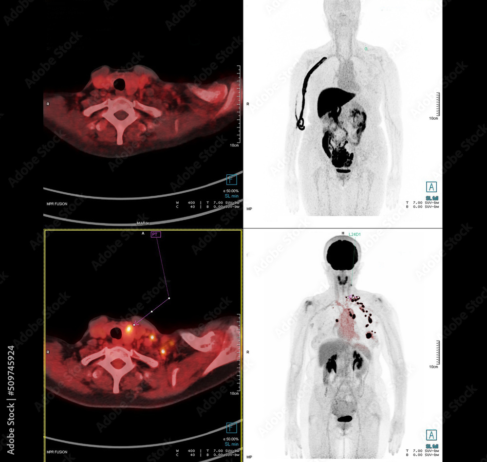 PET Scan image of thorax or chest Comparison Axial , Coronal for detect ...