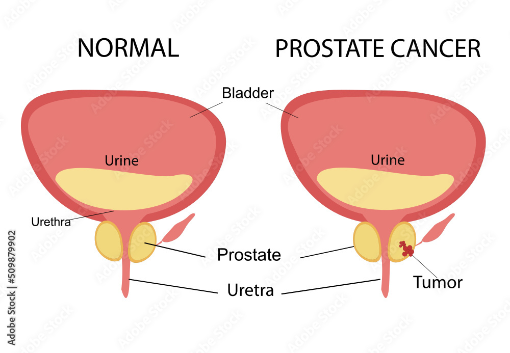 Healthy prostate and prostate cancer. Illustration of male reproductive ...
