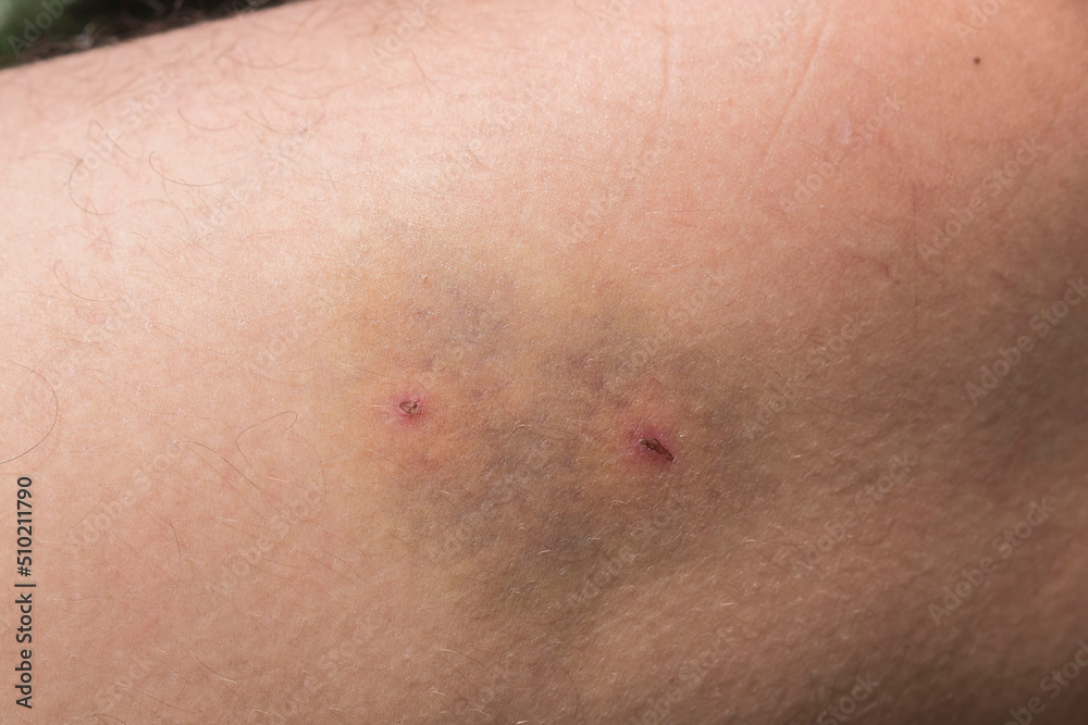 Two puncture wounds and bruising on the left inner thigh caused by ...